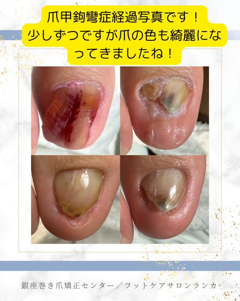 爪甲鉤彎症経過写真 | Foot Care Salon Runka